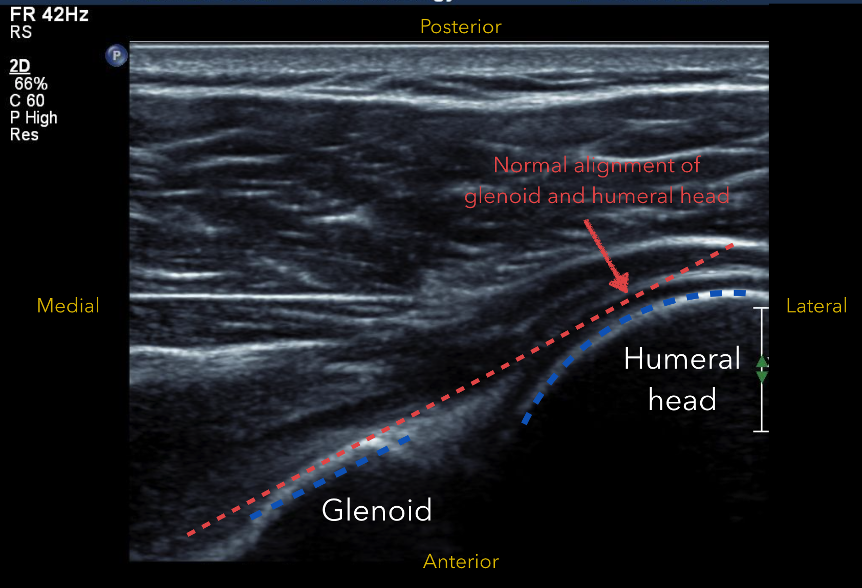 Musculoskeletal Archives UCSD Ultrasound Musculoskeletal Archives UCSD Ultrasound