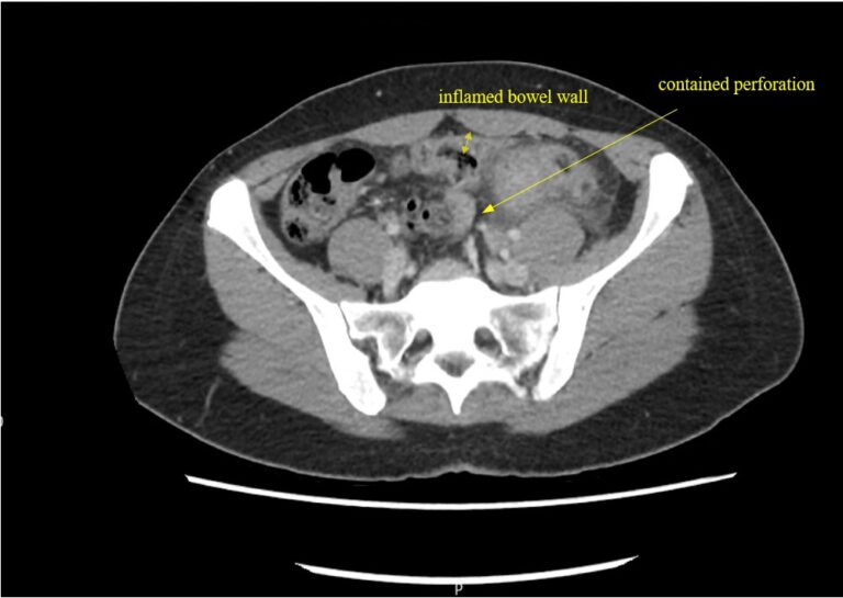 Case 29: Perforated Diverticulitis - UCSD Ultrasound