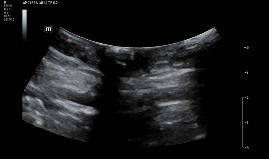 Case 36: Retained Shrapnel - UCSD Ultrasound
