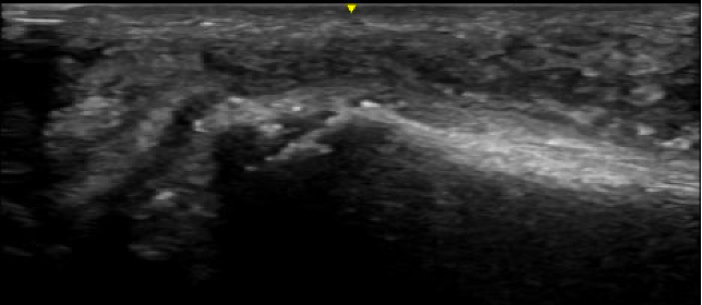 Case 45: Distal Both Bone Fracture - UCSD Ultrasound