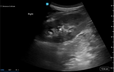 Case 42: Nephrolithiasis - UCSD Ultrasound