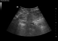 Case 47: Abdominal Wall Perforation - UCSD Ultrasound