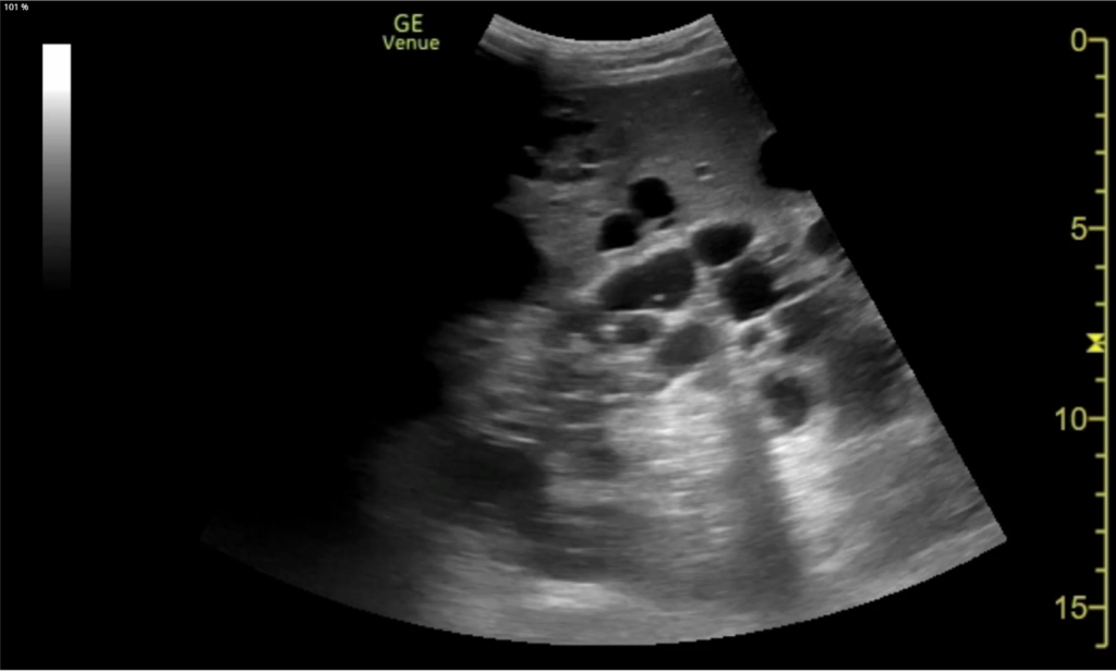 Case 54: Point-of-Care Ultrasound in Polycystic Kidney Disease with ...
